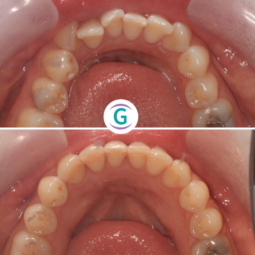 Straight Teeth - Glendair Dental
